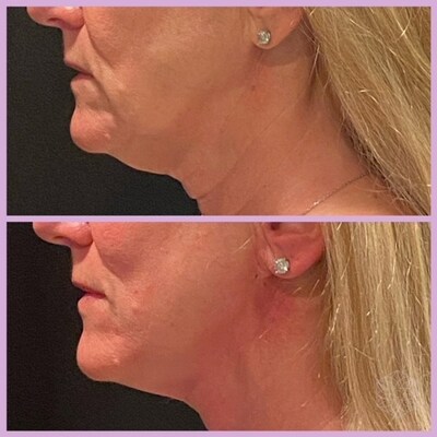 PDO Max® Launches PDO MAX DUO™ PDO Threads: Advanced Precision for ...