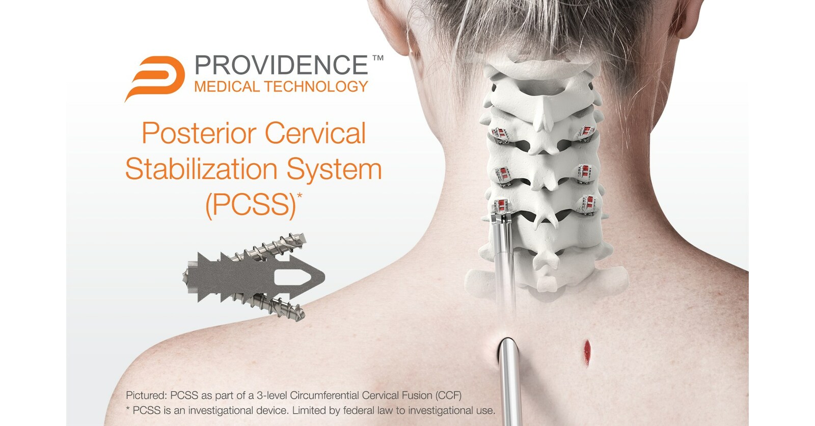 Providence Medical Technology Announces Completion of Enrollment in the ...