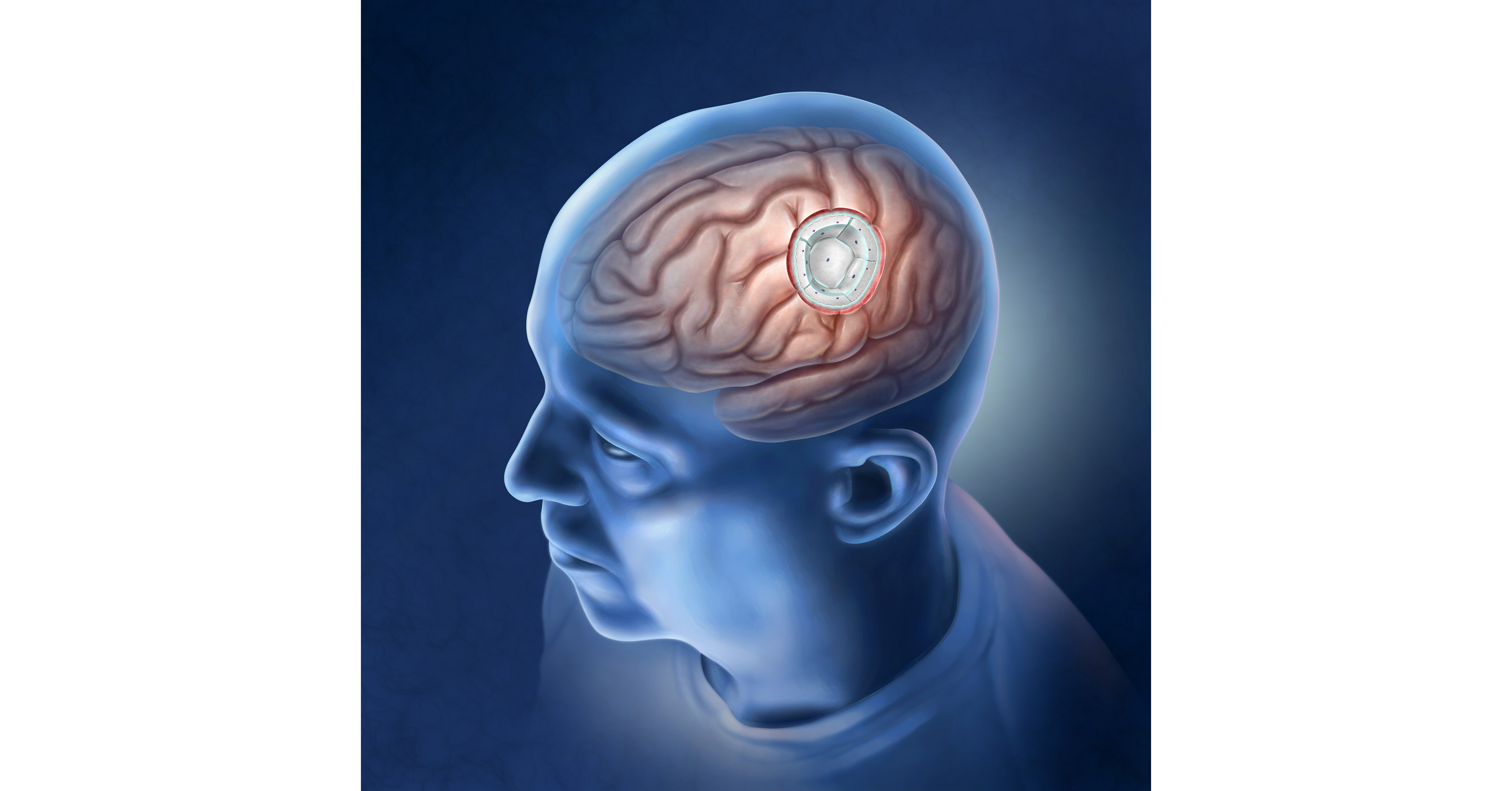 GT Medical Technologies Marks a Significant Milestone: The 1,000th ...