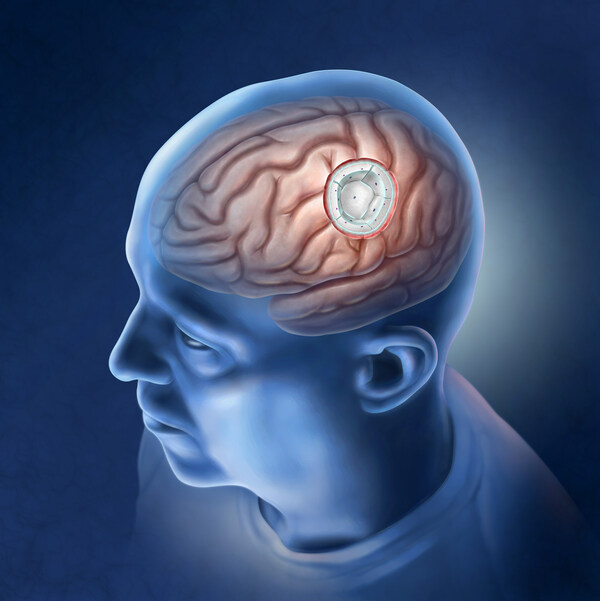 GT Medical Technologies Marks a Significant Milestone: The 1,000th ...