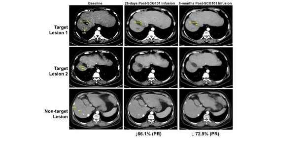 ISCT 2023: Late-breaking SCG101 Data Show 100% HBsAg+ Hepatocyte ...
