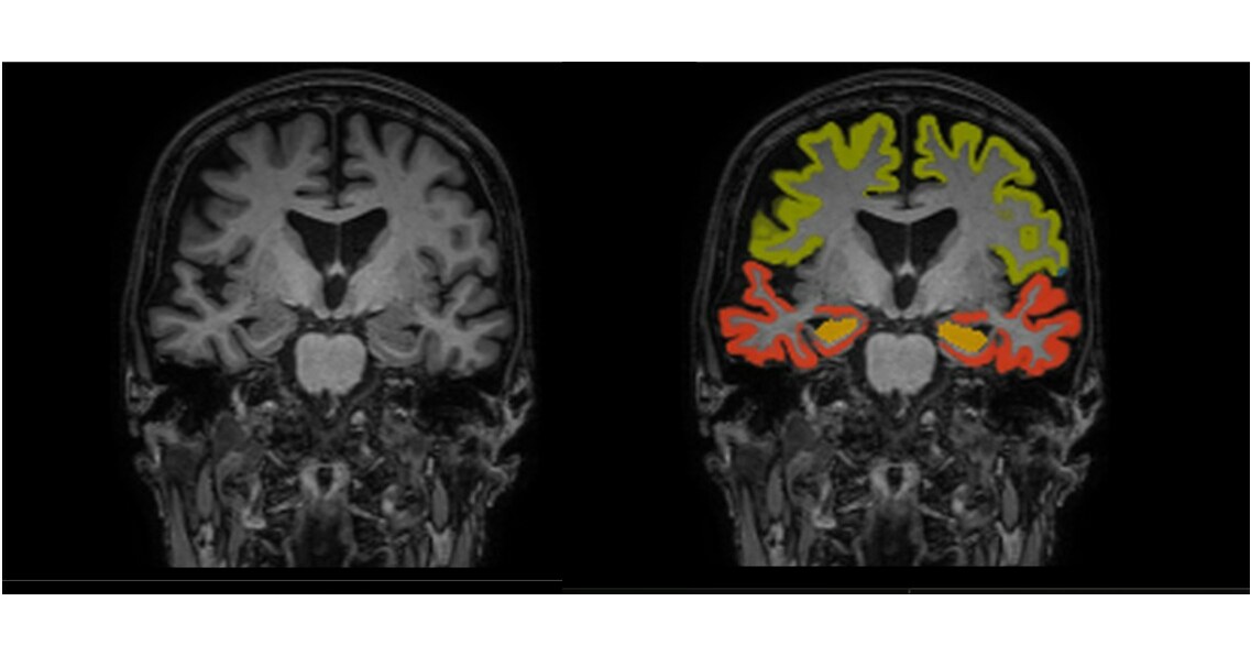 icometrix awarded a grant by The Michael J. Fox Foundation to research ...