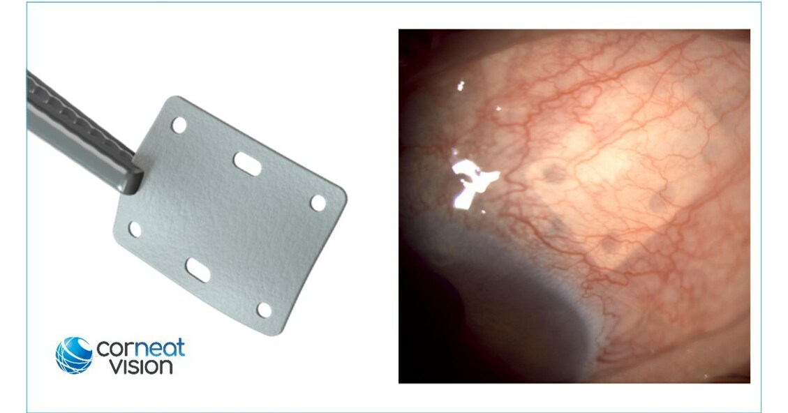 FDA Clears CorNeat EverPatch, World's First Non-degradable, Synthetic ...