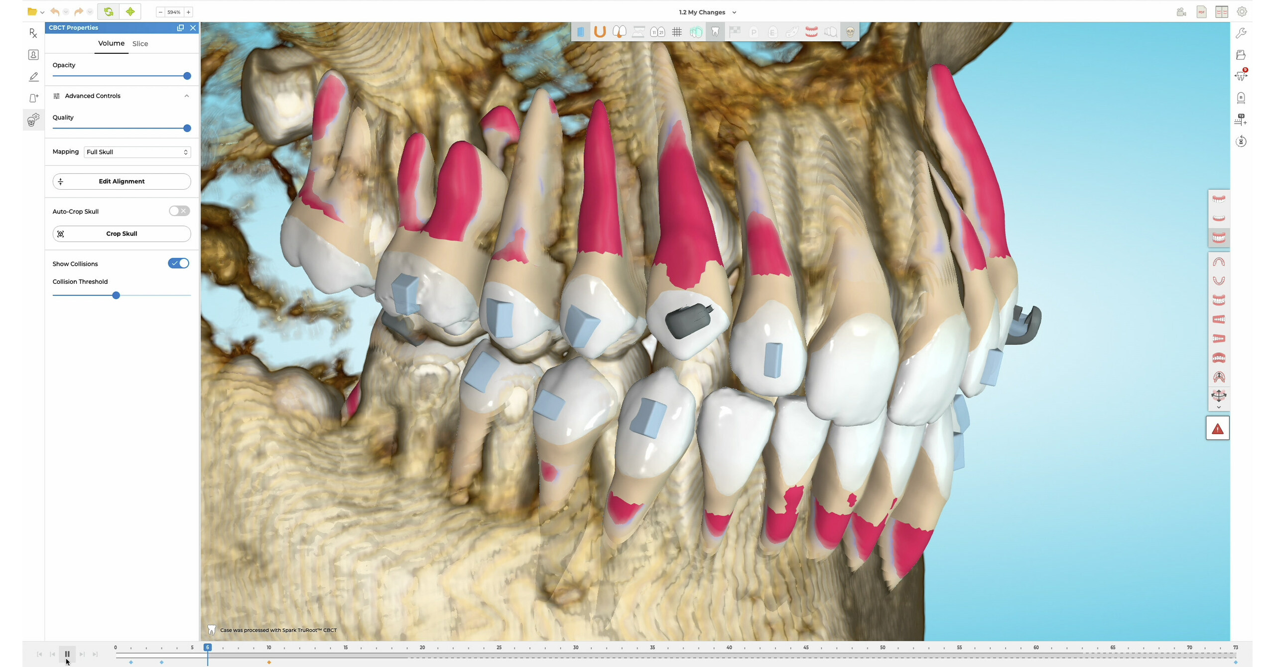 SPARK™ CLEAR ALIGNERS ANNOUNCES KEY CLINICAL UPDATES & DOCTOR-DRIVEN ...
