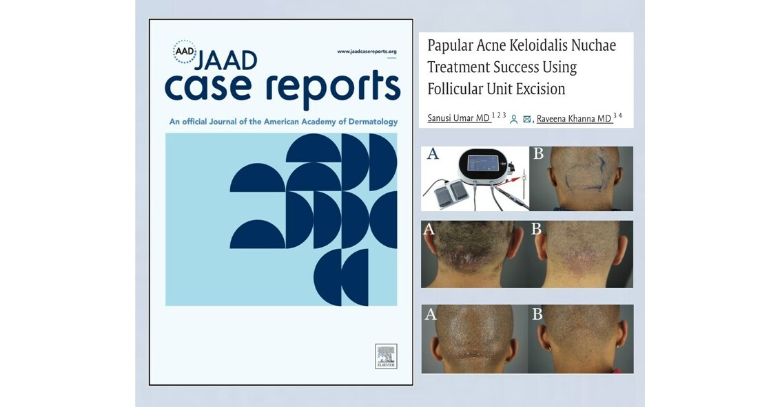 New Hope for Treating Acne Keloidalis Nuchae (AKN) Revealed in Recent Study