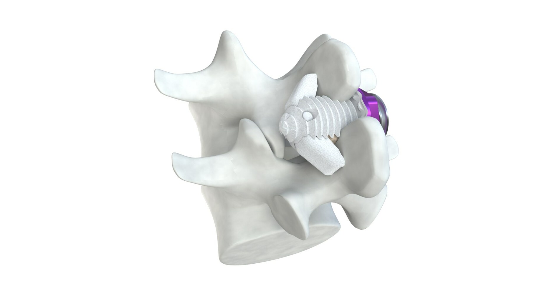 Spinal Simplicity Announces New Real-World Fusion Study for Its ...