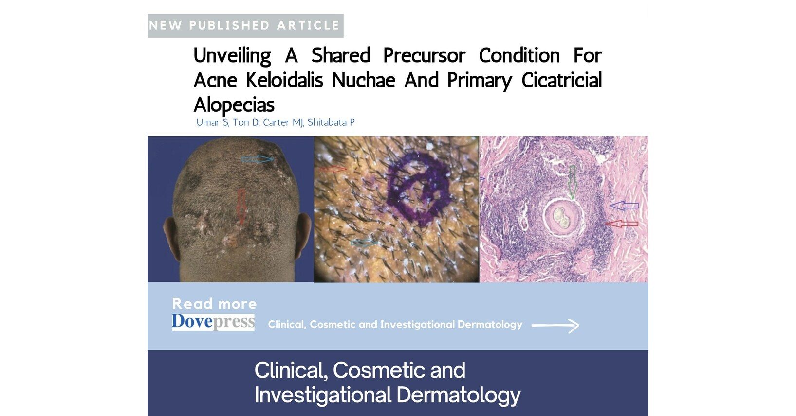 New Study Uncovers Shared Precursor Condition for Acne Keloidalis ...