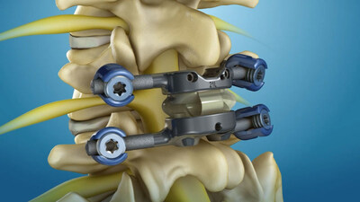 Premia Spine Announces New Technology Add-On Payment for TOP™ System
