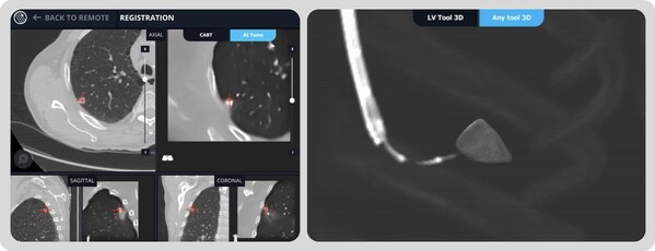 Body Vision Medical Latest Software Release Enhances LungVision™ System ...