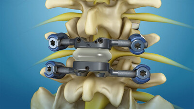 Premia Spine Launches FDA-Approved TOPS™ System at North American Spine ...