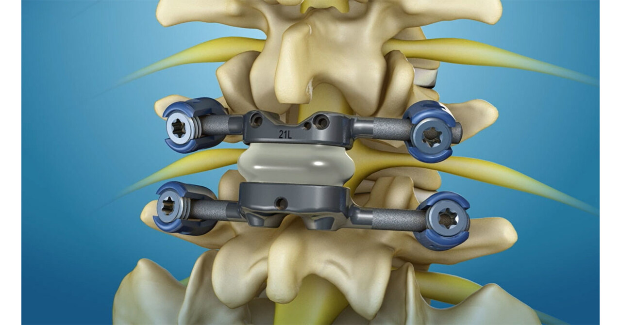 Premia Spine Launches FDA-Approved TOPS™ System at North American Spine ...