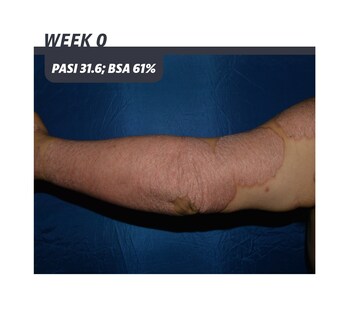 BIMZELX® Approved by the U.S. FDA for the Treatment of Adults with ...