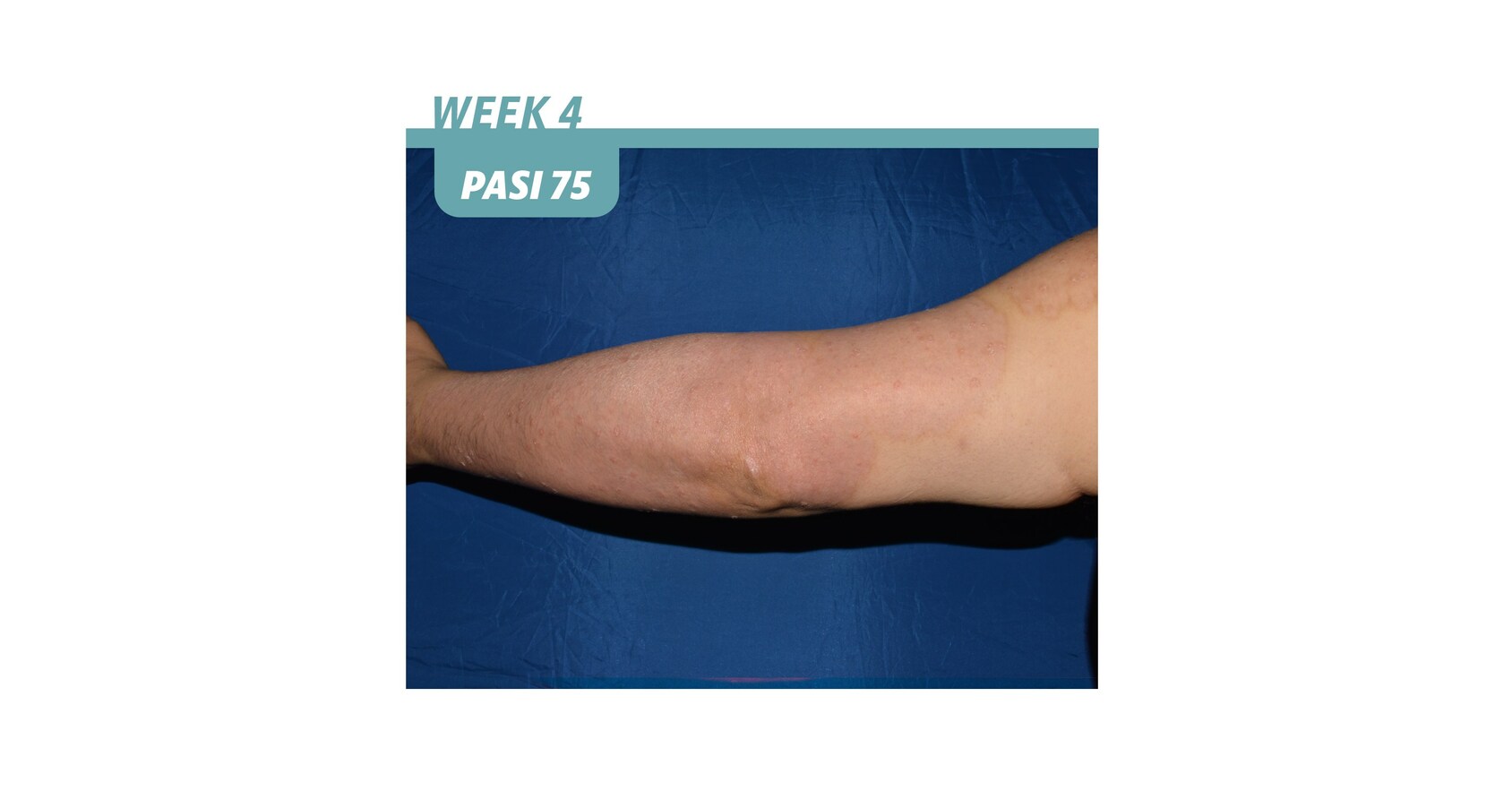 BIMZELX® Approved by the U.S. FDA for the Treatment of Adults with Moderate-to-Severe Plaque ...