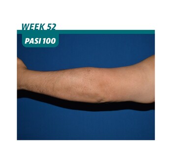 BIMZELX® Approved by the U.S. FDA for the Treatment of Adults with Moderate-to-Severe Plaque ...