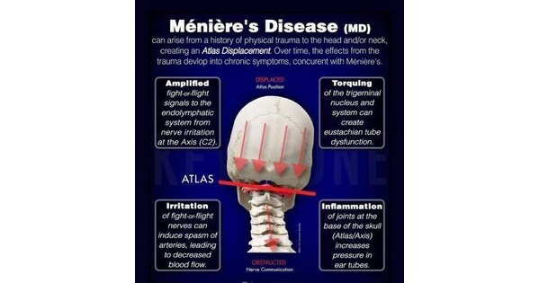 Meniere's Disease Institute Celebrates 25 Years of Successful Treatment ...