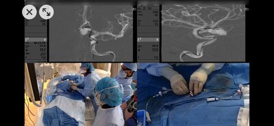Memorial Neuroscience Institute Performs Livestreamed Brain Aneurysm ...