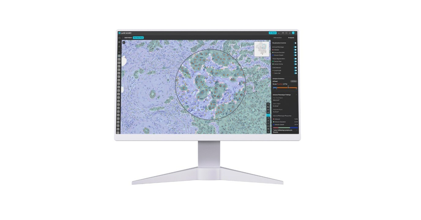 AI-Powered TIL Analysis by Lunit Unveils Prognostic Insights for Colon ...