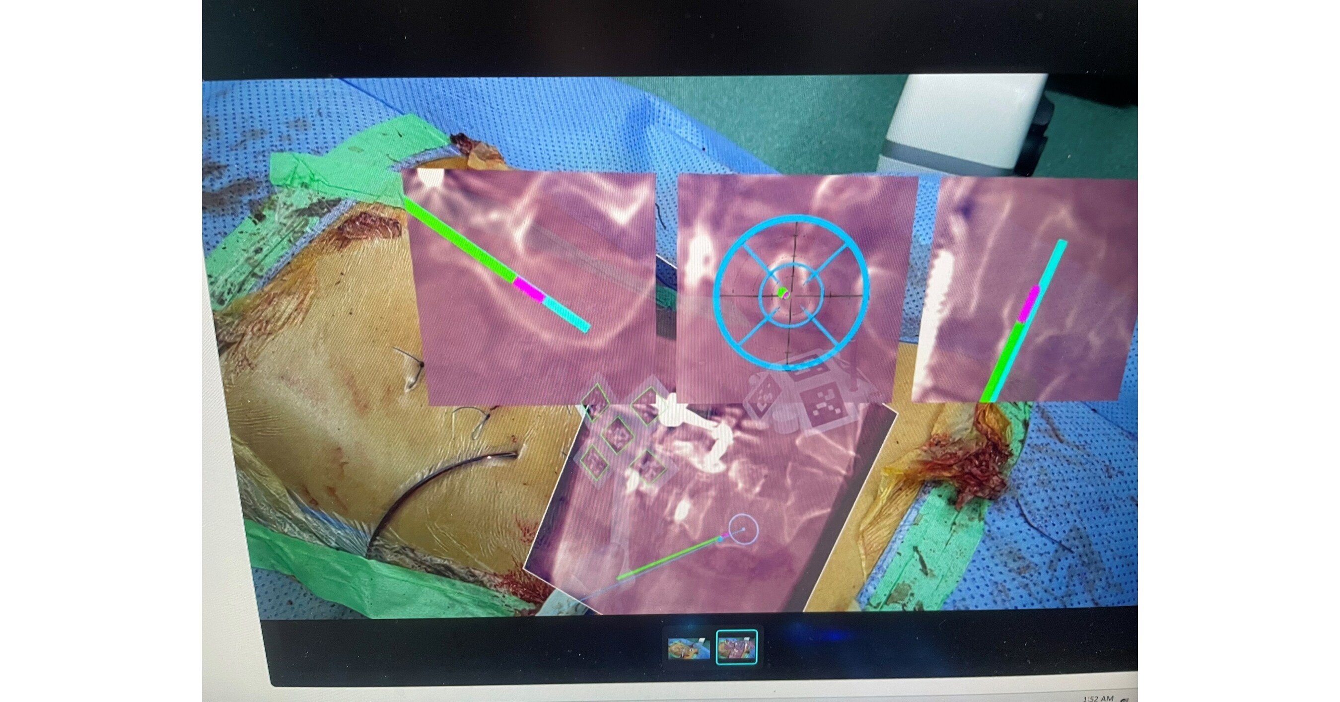 World's first pediatric deformity case using immersive augmented ...