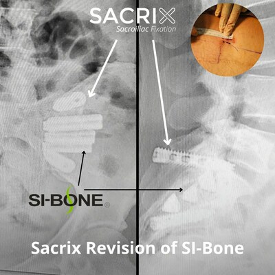 Sacrix Provides Safe Alternative to Risky Revision Spine Surgery ...