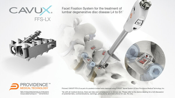 Providence Medical Technology Announces FDA Clearance of CAVUX® FFS-LX Lumbar Facet Fixation ...