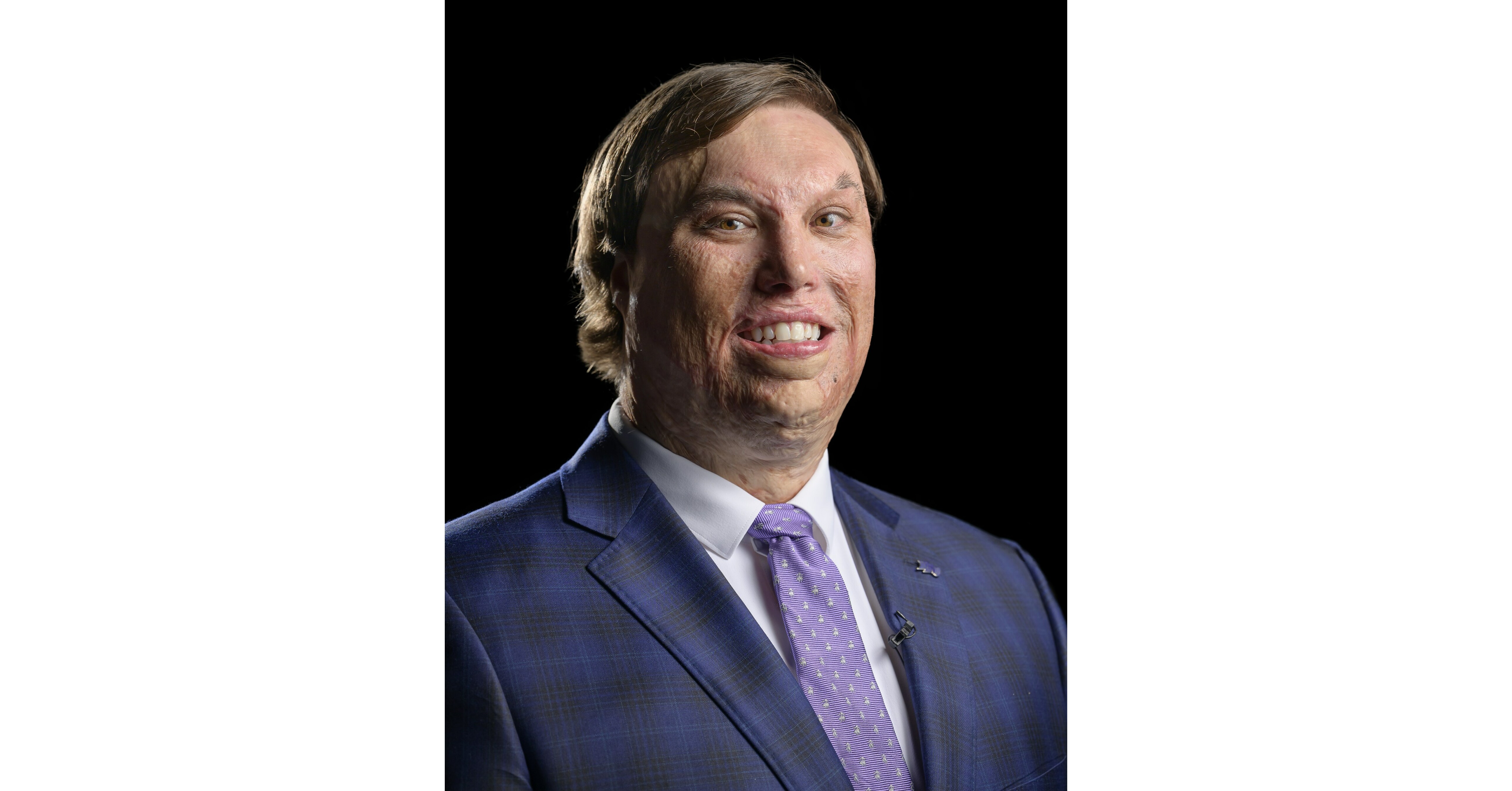 Burn Survivor Connor McKemey to Launch Book Tour at Seacrest Studios in ...