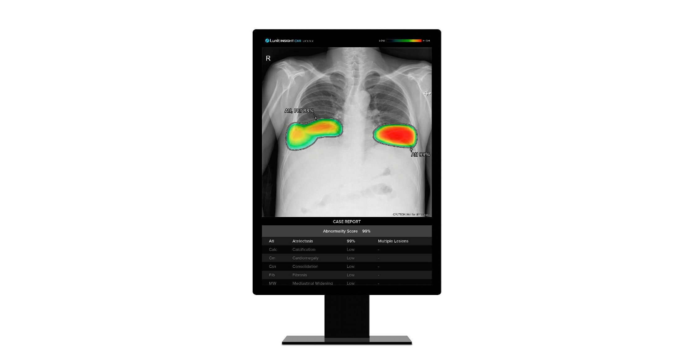 Lunit AI Solutions to Power Samsung's X-ray Devices for Advanced Chest ...