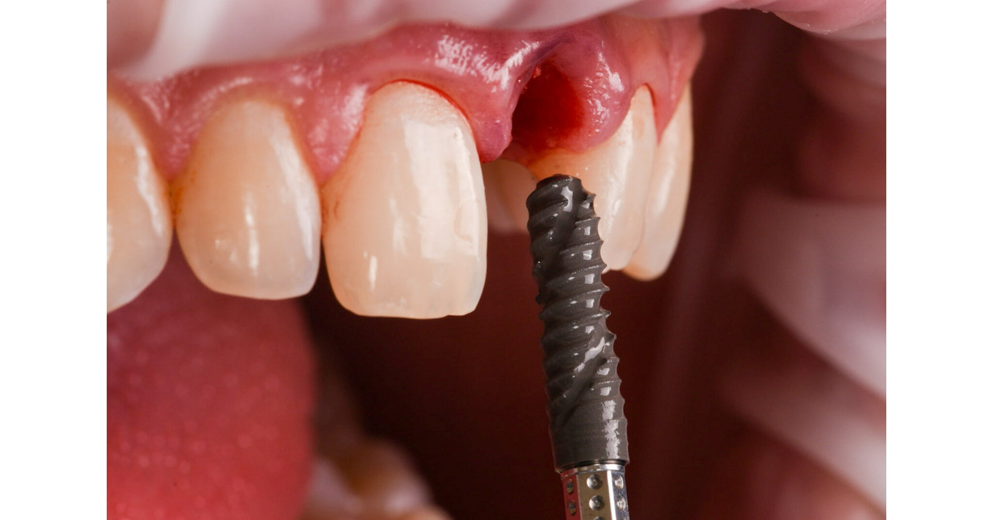 Misch Implant Institute Sets the Standard in Implant Dentistry Education