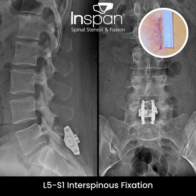 Revolutionizing Spine Surgery Techniques: InSpan Publishes First L5-S1 ...