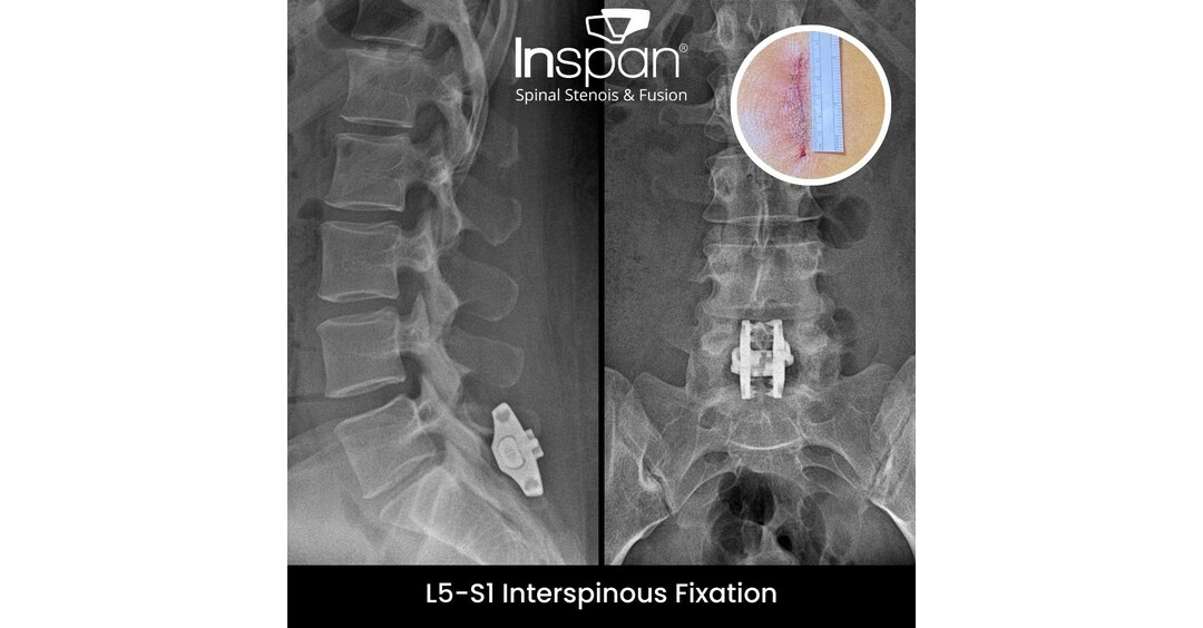 Revolutionizing Spine Surgery Techniques: InSpan Publishes First L5-S1 ...