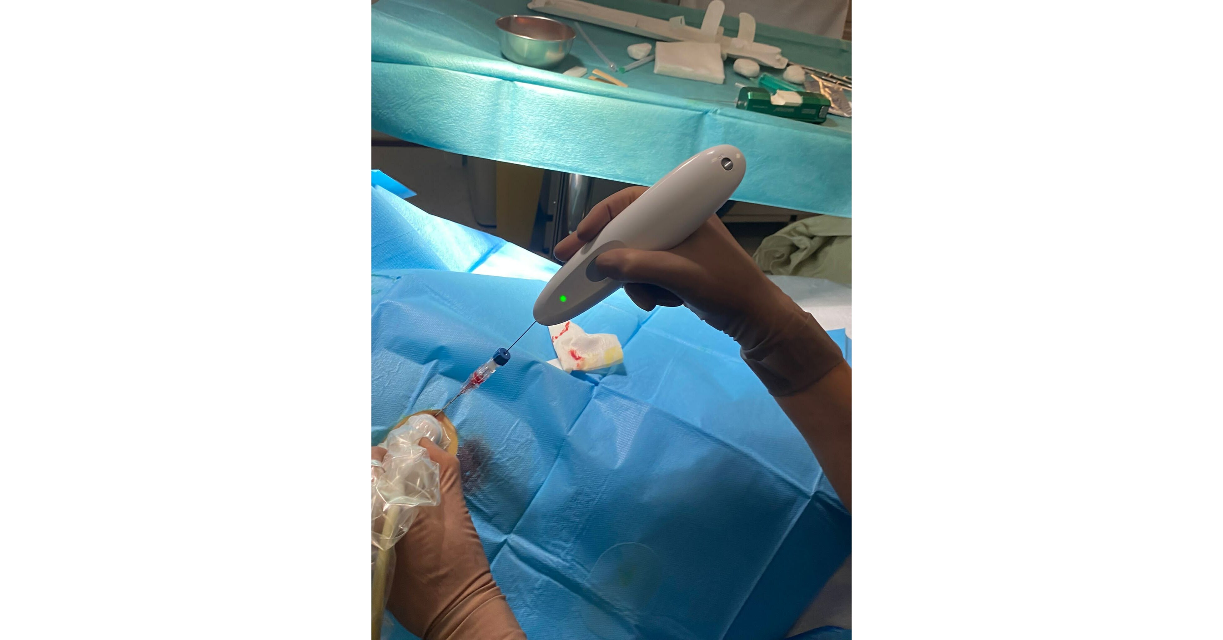 Single Pass and Mermaid Medical Group Announce Exclusive US ...