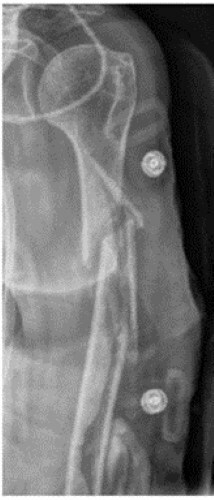 Curing with Light! IlluminOss Celebrates 10,000 Light-Cured Implants ...