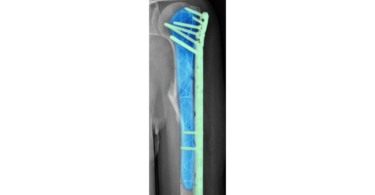 Curing with Light! IlluminOss Celebrates 10,000 Light-Cured Implants ...