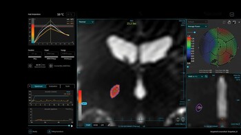 INSIGHTEC ANNOUNCES EXABLATE PRIME -THE NEXT GENERATION OF MR-GUIDED ...