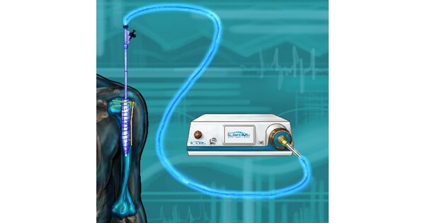 IlluminOss Receives 510K Clearance for a New Light Console for its ...