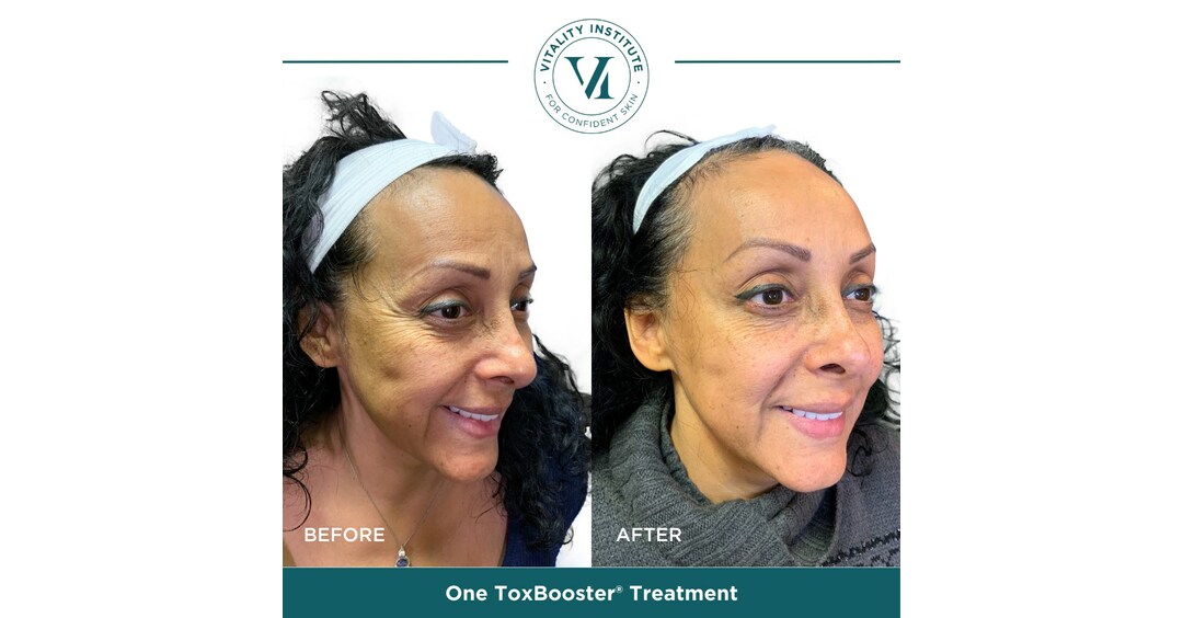 VI Peel® Announces 36% Boost in Anti-Aging Benefits of Botox® from New ...
