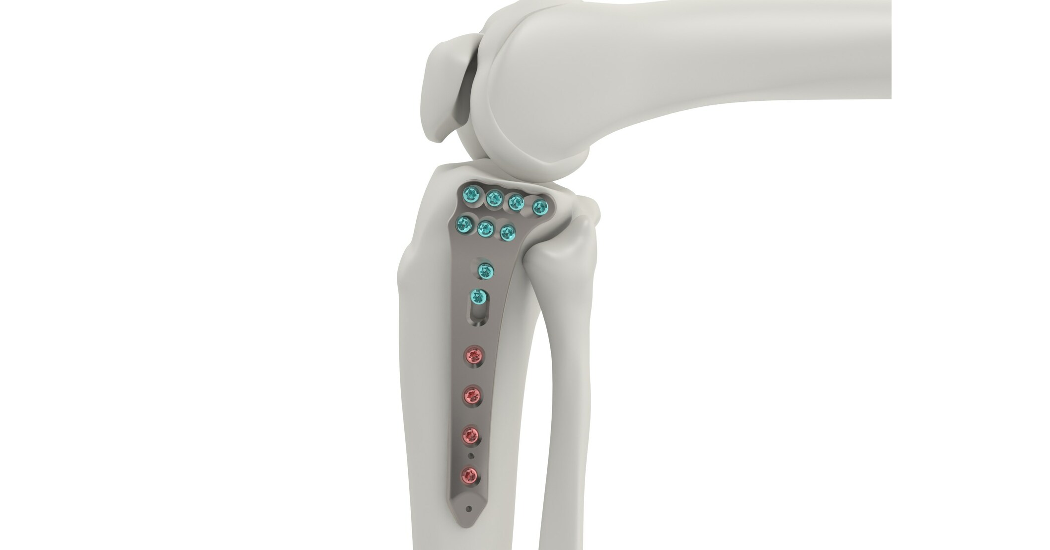 Tyber Medical Acquires FDA Clearance for Proximal Tibia Plating System