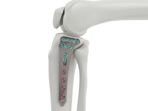 Tyber Medical Acquires FDA Clearance for Proximal Tibia Plating System