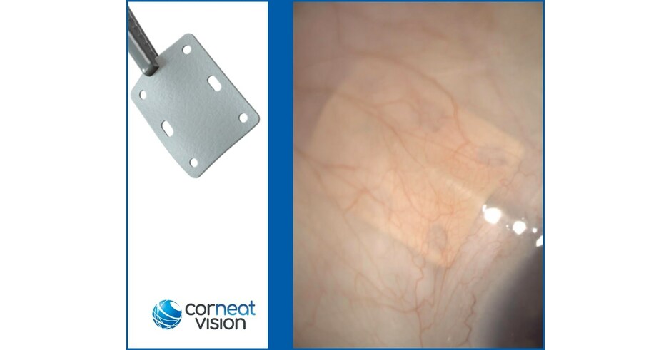 CorNeat EverPatch Hits the US Market: Farewell to Traditional Ocular ...
