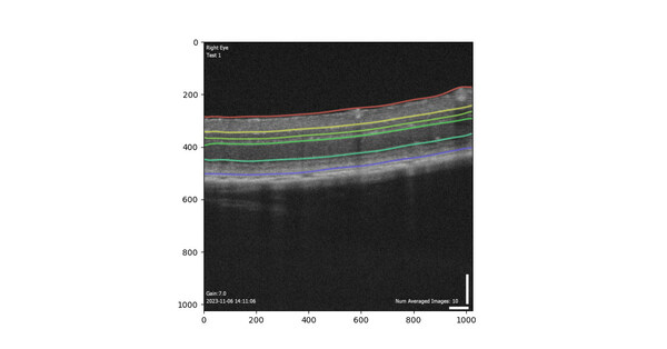 Phoenix-Micron Enhances OCT Imaging with AI-powered OCT Segmentation