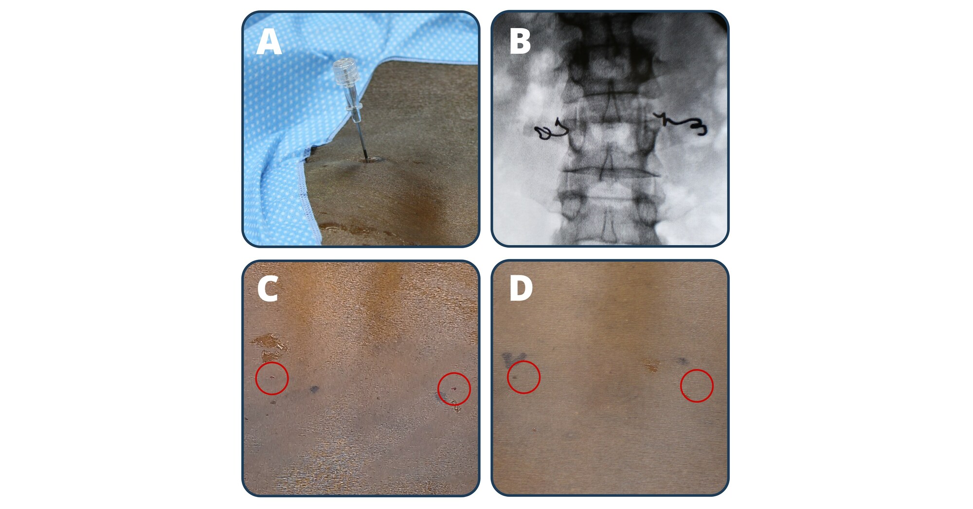 Neuronoff Announces Safety and Functionality Success in First-in-Human ...