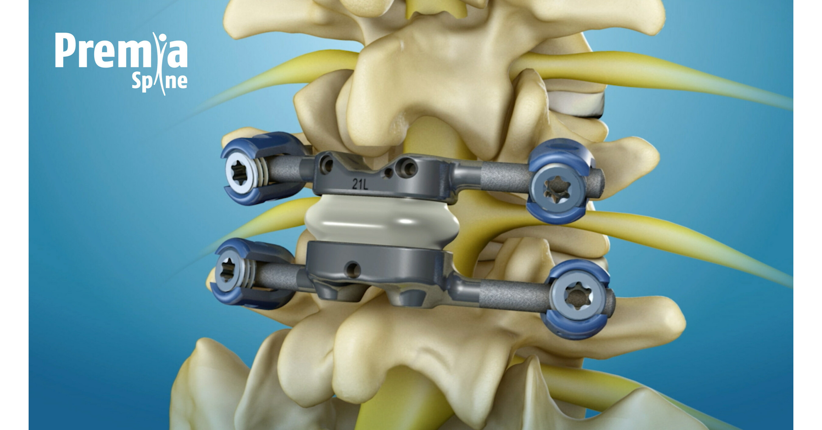 Facet Replacement FDA Study Garners Best Paper Award At Lumbar Spine ...