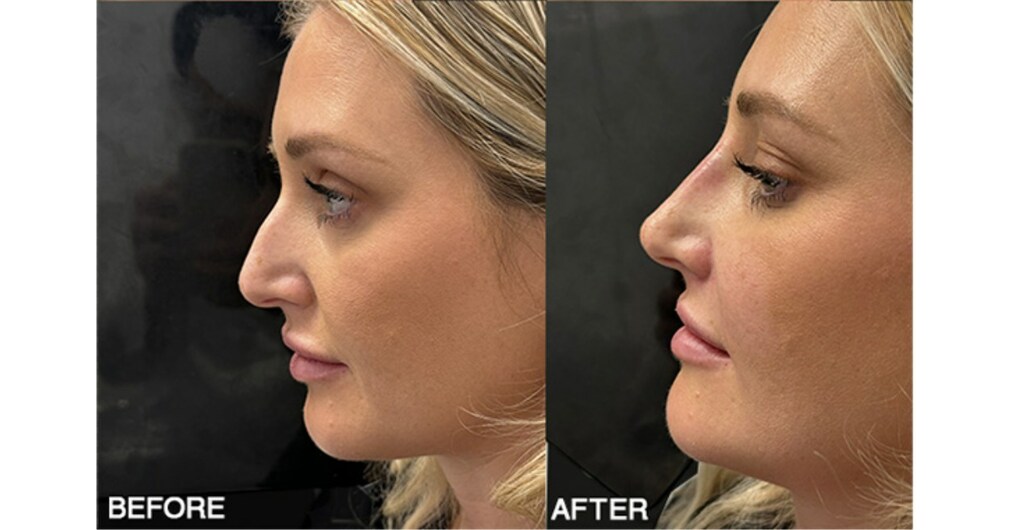 Non-Surgical Nose Job by Dr. Simon Ourian, A New Nose in 30 Minutes?