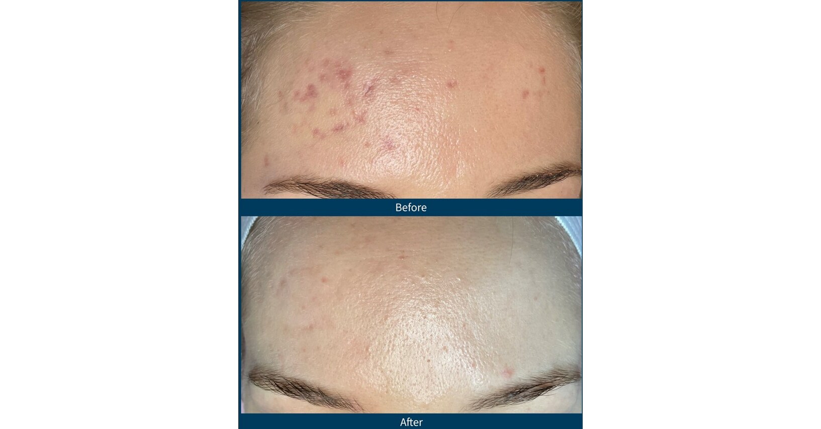 Regen Wellness Announces Microneedling as a More Natural Skin Treatment