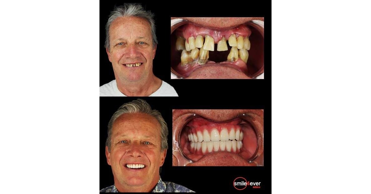 Dental Tourism | The Best Dentists Option in Tijuana Mexico - Smile 4 ...