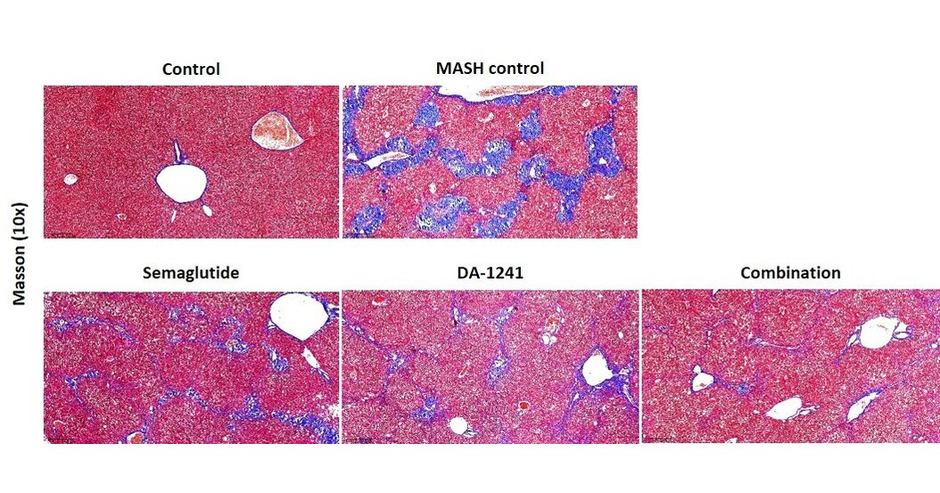 NeuroBo Pharmaceuticals' DA-1241 in Combination with Semaglutide ...