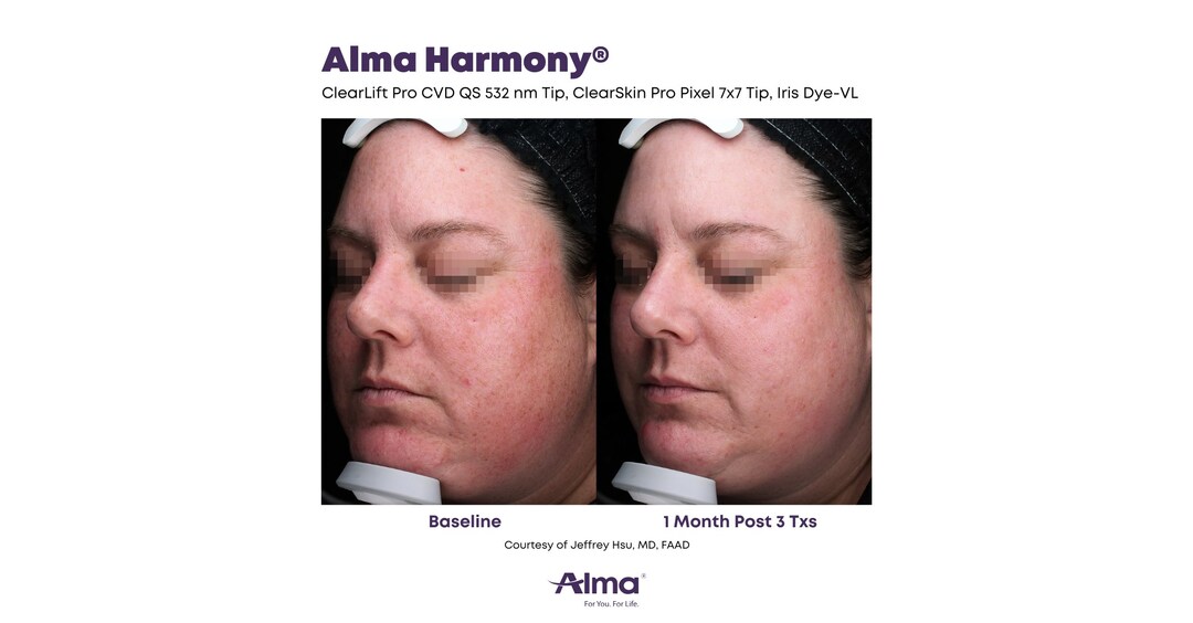 Alma Unveils Alma Harmony™ and Alma IQ™ in U.S. Market, Advancing ...