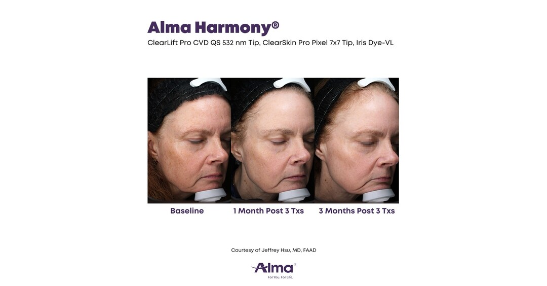 Alma Unveils Alma Harmony™ and Alma IQ™ in U.S. Market, Advancing Personalization in Aesthetic ...