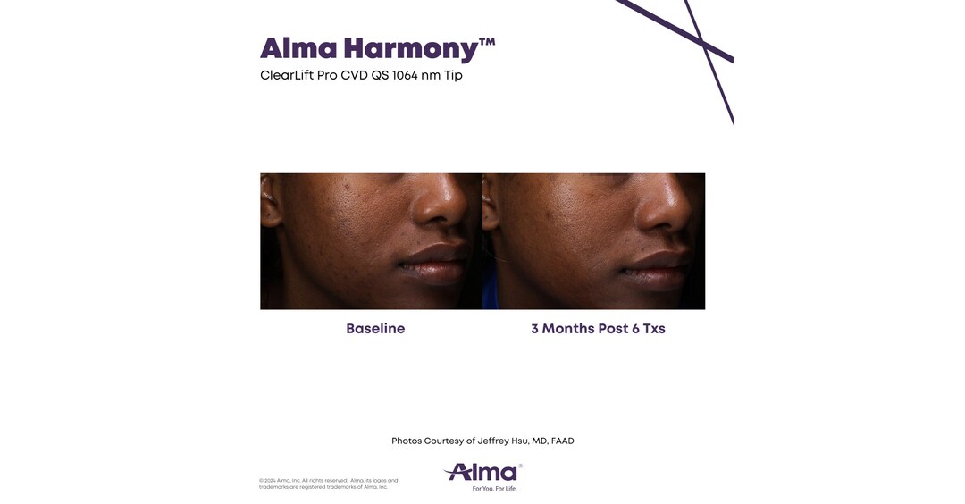 Alma Unveils Alma Harmony™ and Alma IQ™ in U.S. Market, Advancing ...