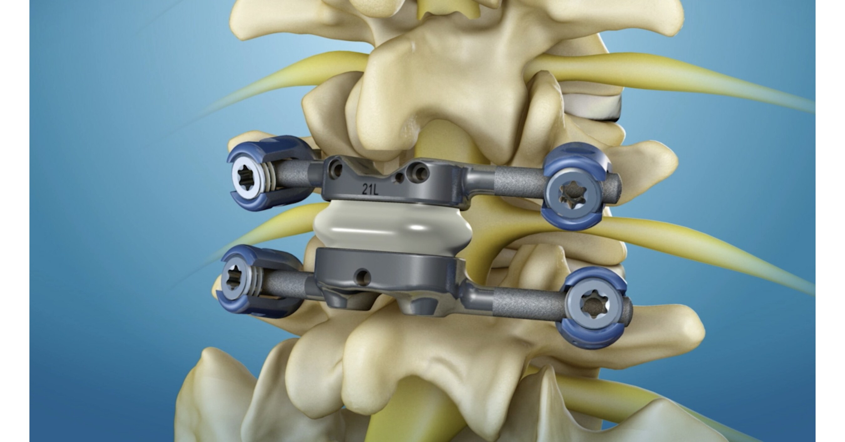 Landmark FDA Study Demonstrates Superior Outcomes of Lumbar Facet ...