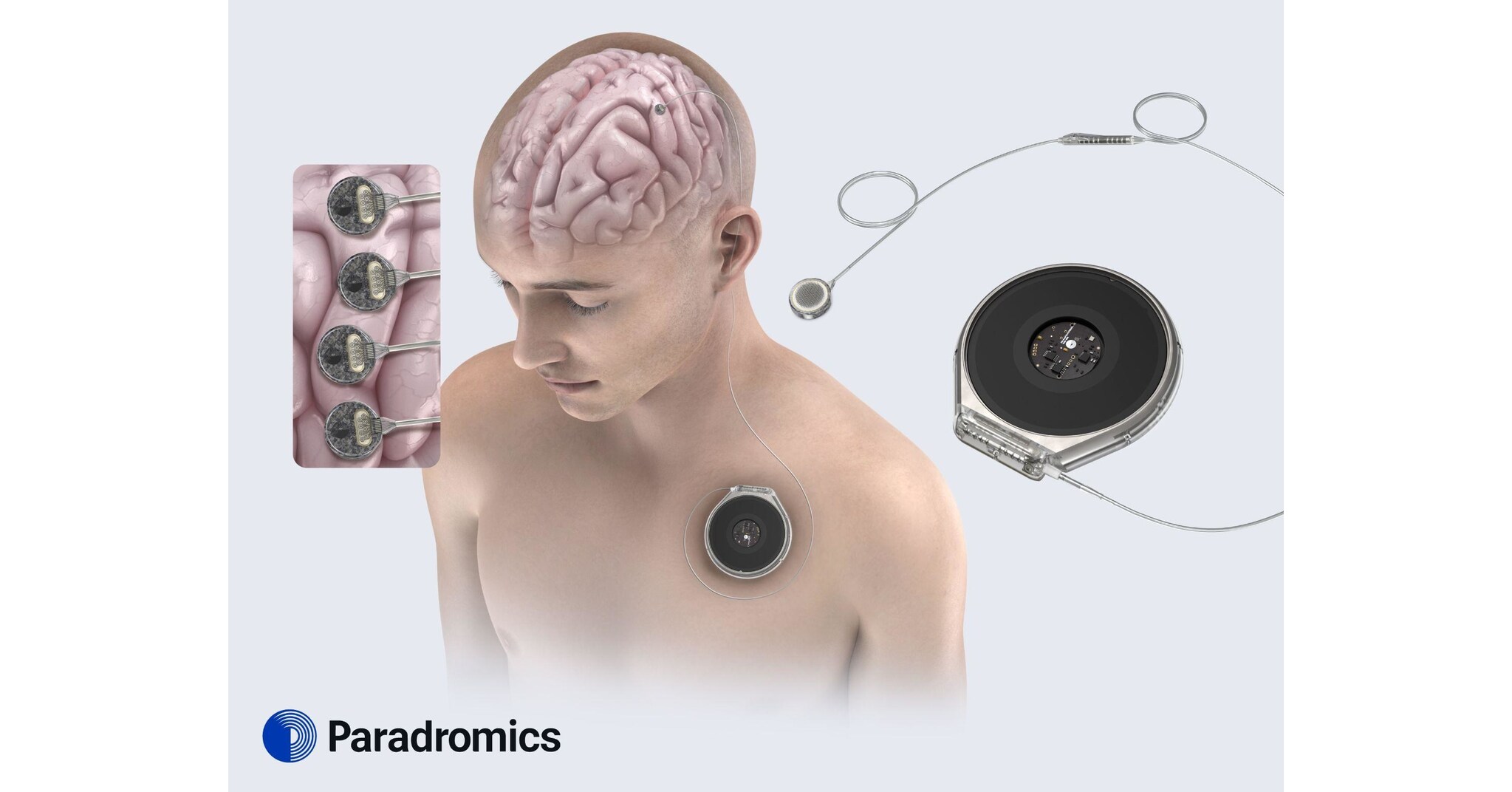 Paradromics accepted to FDA regulatory accelerator program and ...